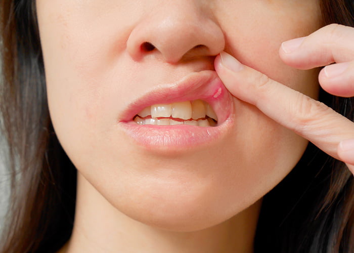Blisters Inside Lip After Dental Procedure Infoupdate